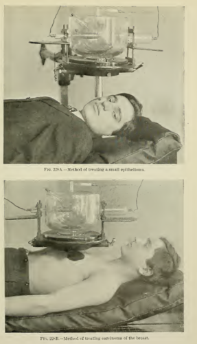 Origins of radiotherapy in cancer treatment - Rincón educativo